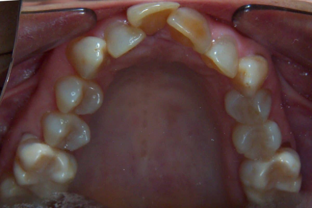 PATIENT PROFILE: ADULT/INVISALIGN - Legacy Smiles