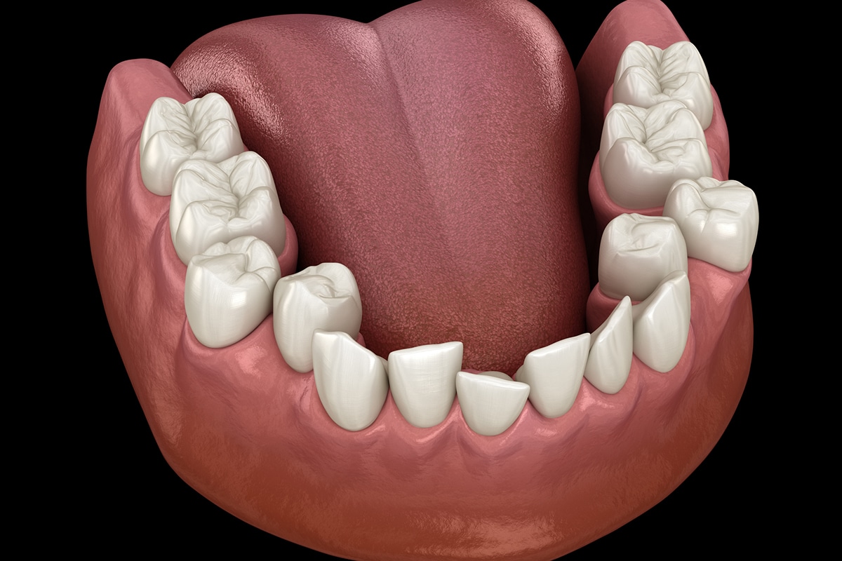 Understanding Dental Crowding - Legacy Smiles